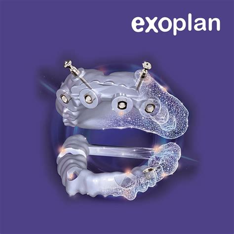 Exoplan For The Guide Creator Medimatch Dental Laboratory