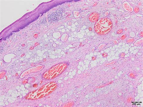 The Histopathology Of The Fibrovascular Polyp Hematoxylin And Eosin