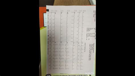 Bifascicular Block Youtube