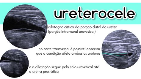 Ureterocele Vem Ver Um Caso