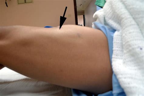 A Rare Form Of Soccer Injury Rectus Femoris Tendon Rupture Hc Chang Orthopaedic Surgery