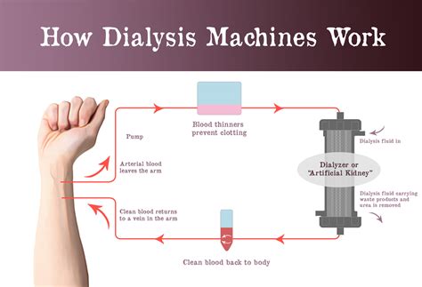 How Hemodialysis Works Gaytri Manek Formerly Gandotra Md