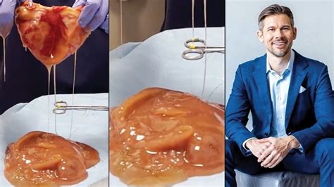 Industrial Grade Silicone Pip Breast Implants Made Woman Ill