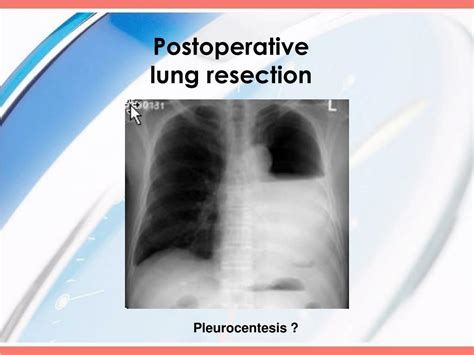 Ppt Lung Resection Powerpoint Presentation Free Download Id819564