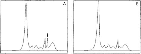 Cze And If Es Electropherograms From A Patient With Light Chain