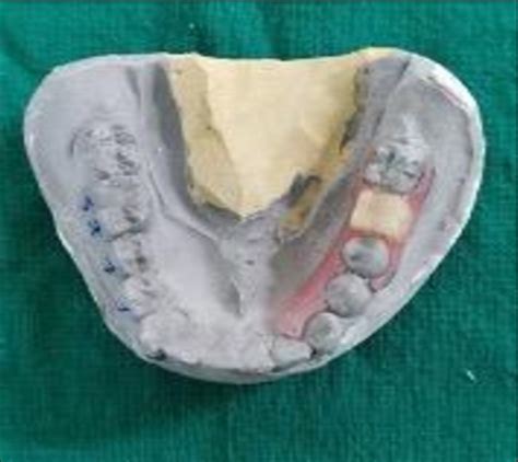 Prosthesis On Cast Occlusal View Download Scientific Diagram