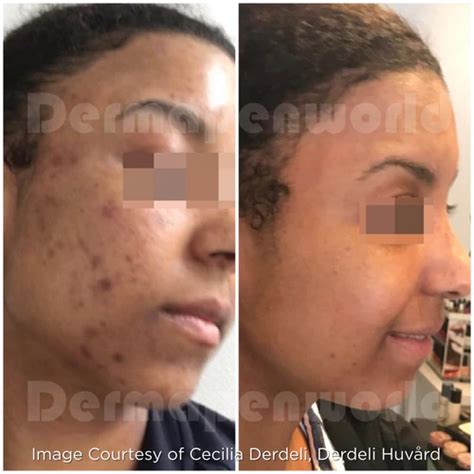 Transform Your Skin Microneedling Before And After Results