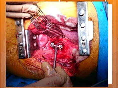 Thoracic Disc Disease Ppt
