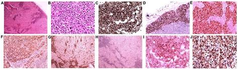 Lymph Node Biopsies Reveal Diffuse And Sinus Proliferation Of Large