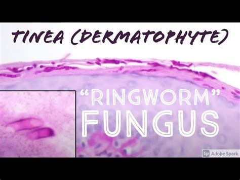 Ringworm Under Microscope