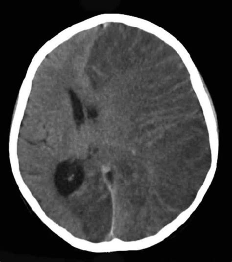 Mri Scan For Encephalitis Diagnosis