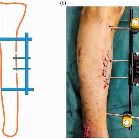 The Procedure Of Tibial Cortex Transverse Distraction A Schematic