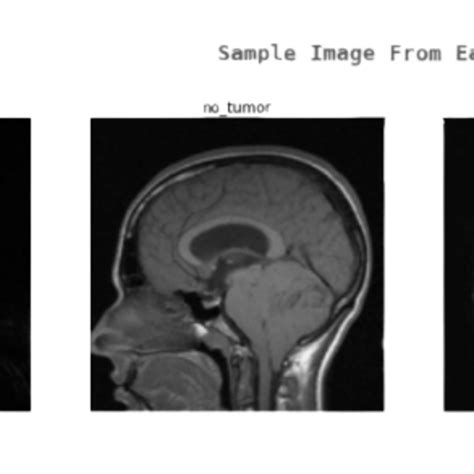 Brain Tumor Classification Kaggle Brain Tumor Classification Kaggle