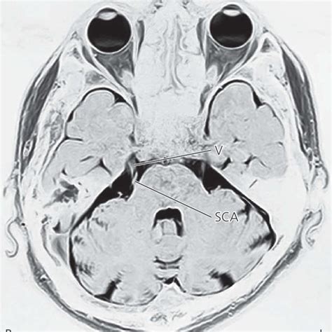 Pdf Effective Microvascular Decompression Of The Trigeminal Nerve In A Patient With Sunct