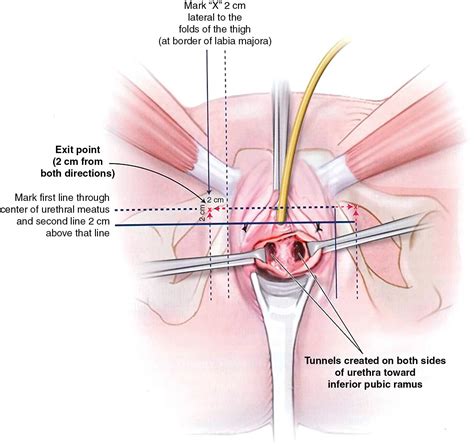Synthetic Midurethral Slings For Stress Urinary Incontinence Clinical