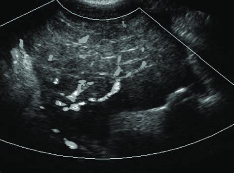 Large Right Sided Solid Vascular Ovarian Mass In A 24 Year Old