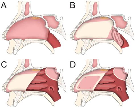 Reducing Nasal Morbidity After Skull Base Reconstruction With The