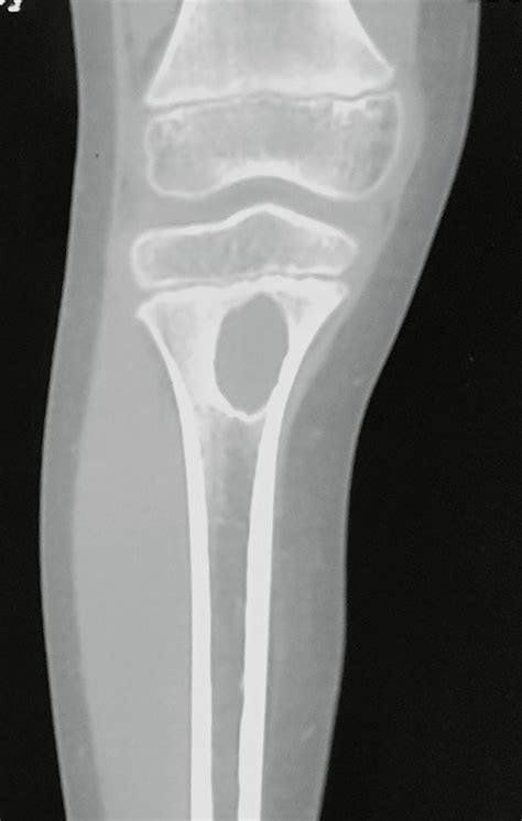Simple Bone Cyst Of The Tibia Oncosurgery