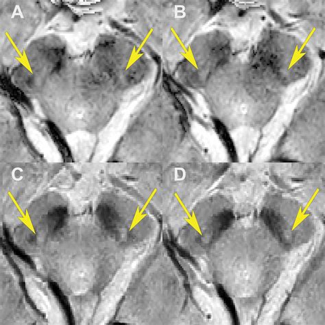 Substantia Nigra Parkinsons Disease