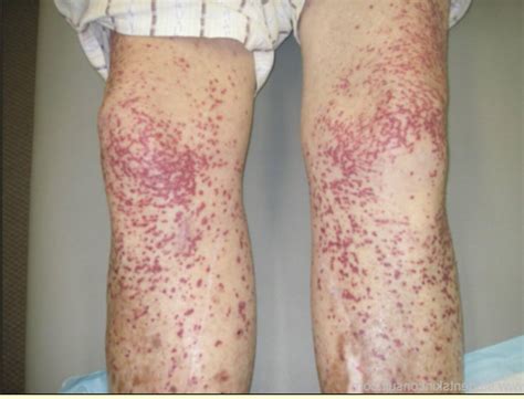 40 Facts About Granulomatous Allergic Angiitis