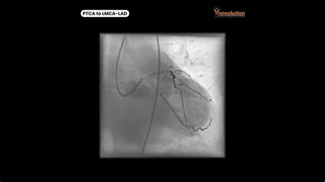 Ptca To Lmca Lad Youtube