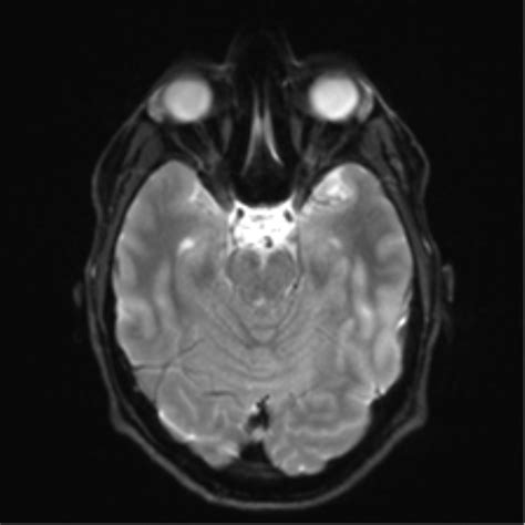Normal Brain Mri Radiopaedia 42777 45943 Axial Dwi Nc Commons