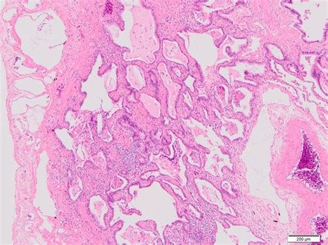 Pathology Outlines Respiratory Bronchiolitis Pathology Outlines Uip