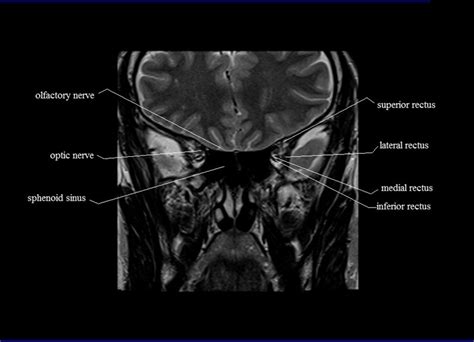 Orbits Anatomy Mri Orbits And Paranasal Sinuses Anatomy Free Cross