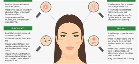 Hormonal Acne Types Causes Diagnosis Treatment Healthy Food Near Me