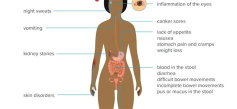 Inflammatory Bowel Disease Causes Symptoms Treatment Healthy Food Near Me
