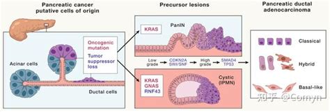 胰腺癌的研究进展与挑战 知乎