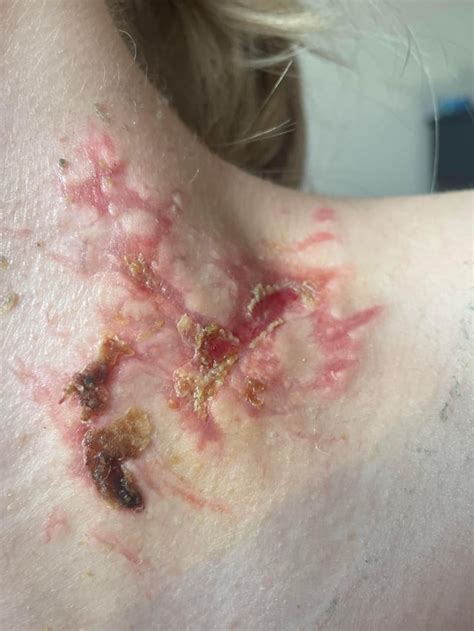 Fresh Neck Scarring Rscars