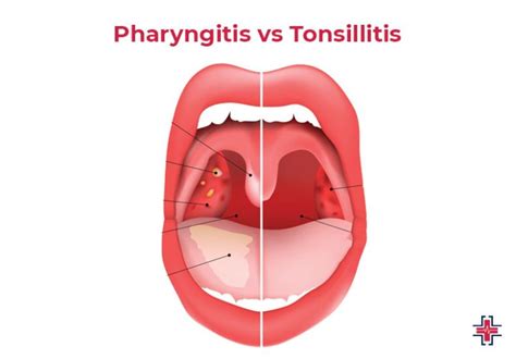Pharyngitis A Comprehensive Guide To Symptoms Causes Prevention And