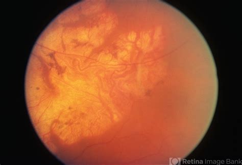 Posterior Pole Chorioretinal Atrophy With Staphyloma Retina Image Bank