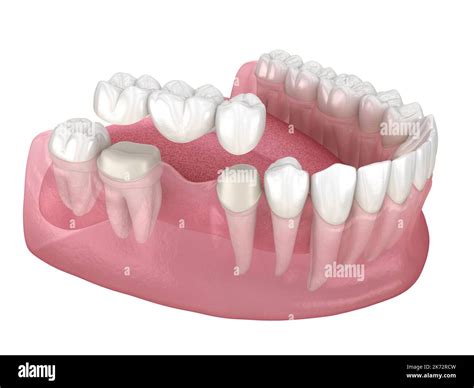 Dental Bridge Of 3 Teeth Over Molar And Premolar Medically Accurate 3d