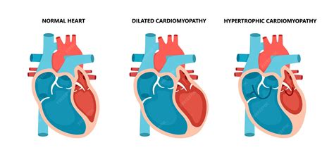 Premium Vector Types Of Heart Diseases Normal Hypertrophic And