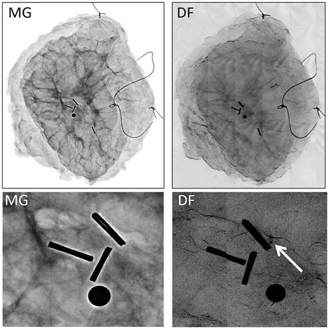 Representative Image Sets Of Combined Mammography And X Ray Dark Field Download Scientific