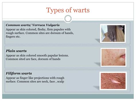 Clinical Tips For The Homoepathic Treatment Of Warts Pptx
