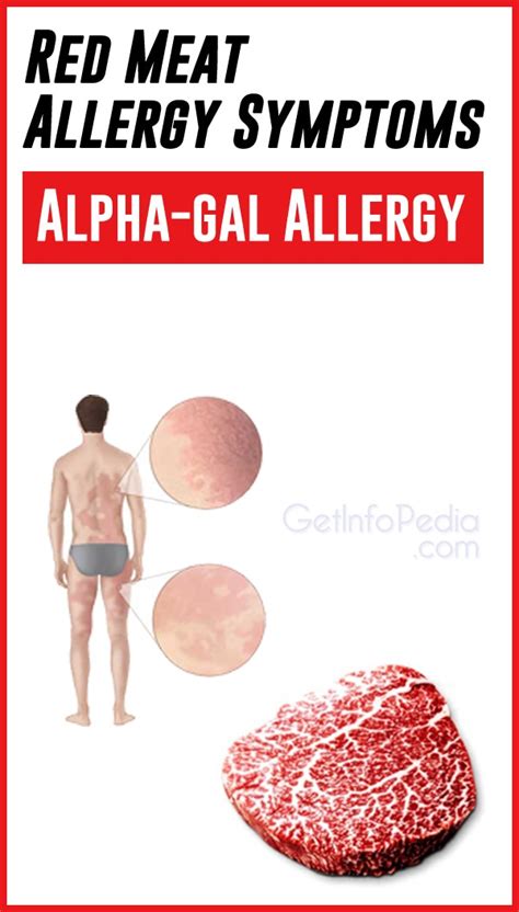 Red Meat Allergy Symptoms Alpha Gal Allergy