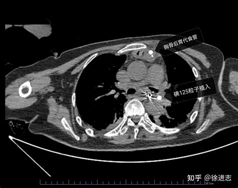 机器人救治气管食管瘘 知乎