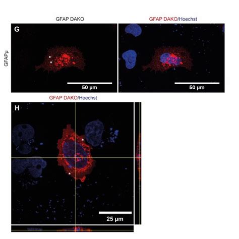 Pdf New Gfap Splice Isoform Gfapμ Differentially Expressed In Glioma Translates Into 21 Kda