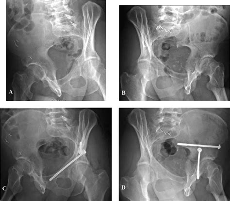 A B Judet Oblique Radiographs Depicting A Minimally Displaced Download Scientific Diagram