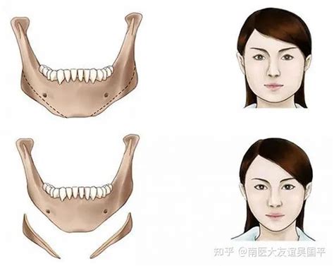 下颌骨鼓应该如何改变 知乎