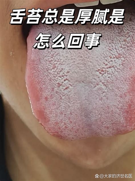 舌苔总是厚腻是怎么回事