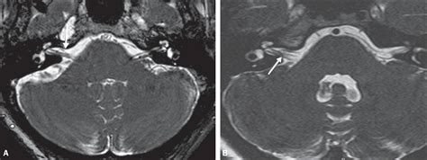 Scielo Brasil Vascular Loops In The Anterior Inferior Cerebellar