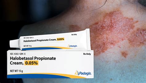 Halobetasol For Psoriasis And Eczema Relief