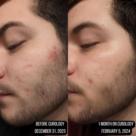 Started Using Curology 1 Month Ago I Think Its Working Banda R