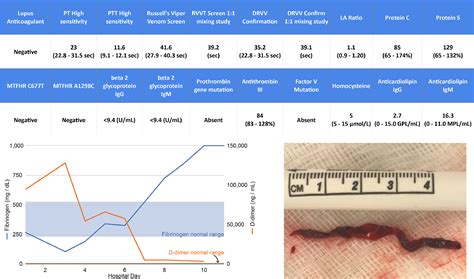 Large Vessel Occlusion Secondary To Covid 19 Hypercoagulability In A