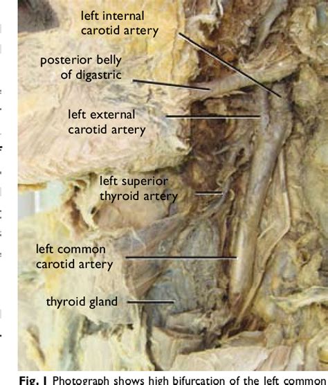 External Carotid Artery Branches Cadaver External Carotid Artery Branches Cadaver