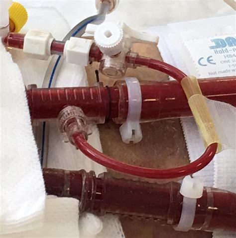 Velia Marta Antonini On Linkedin ‪vascular Complications And Distal